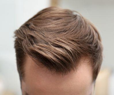 Telogen Effluvium - Hermest Clinic