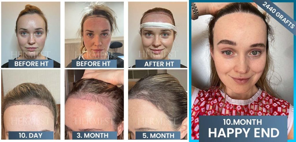 The Top 10 Best Hair Transplant In Turkey - Hermest Clinic