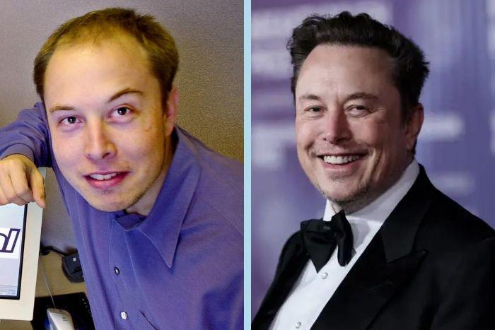 Did Elon Musk Get a Hair Transplant Hermest Clinic