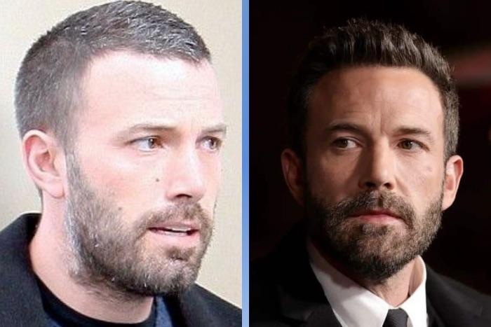 Celebrity Hair Transplants: 45 Transformations & Success Stories ...