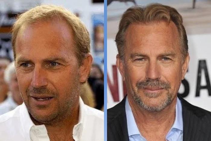 Celebrity Hair Transplants: 45 Transformations & Success Stories ...