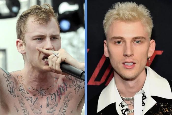 Celebrity Hair Transplants: 45 Transformations & Success Stories ...