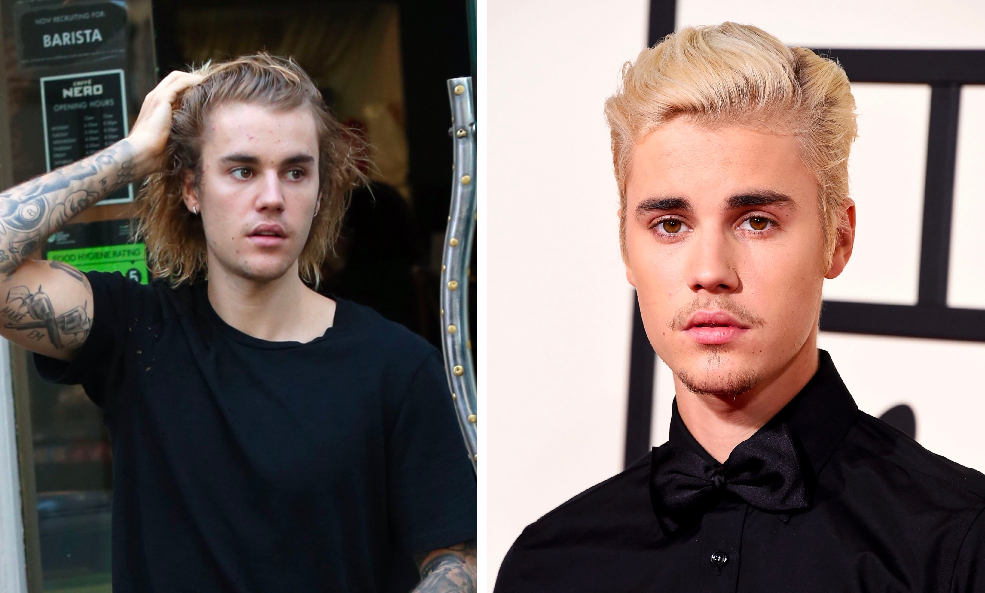 Justin Bieber Hair Transplant Truth Techniques And Results Hermest Clinic
