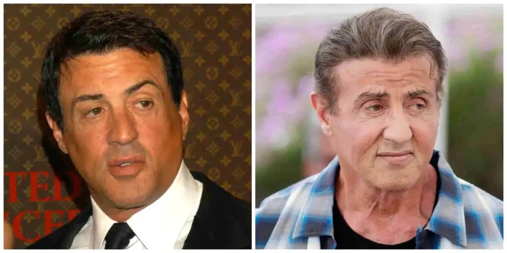 Sylvester Stallone Hair Transplant: Evidence & Techniques