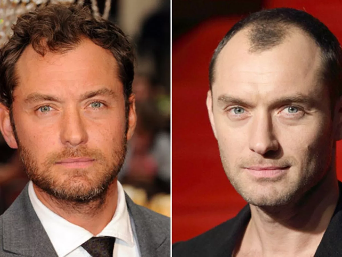 Jude Law Hair Transplant: Did He Restore His Hairline? - Hermest Clinic