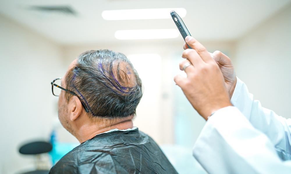 Hair Transplant to the Crown Area - Hermest Clinic