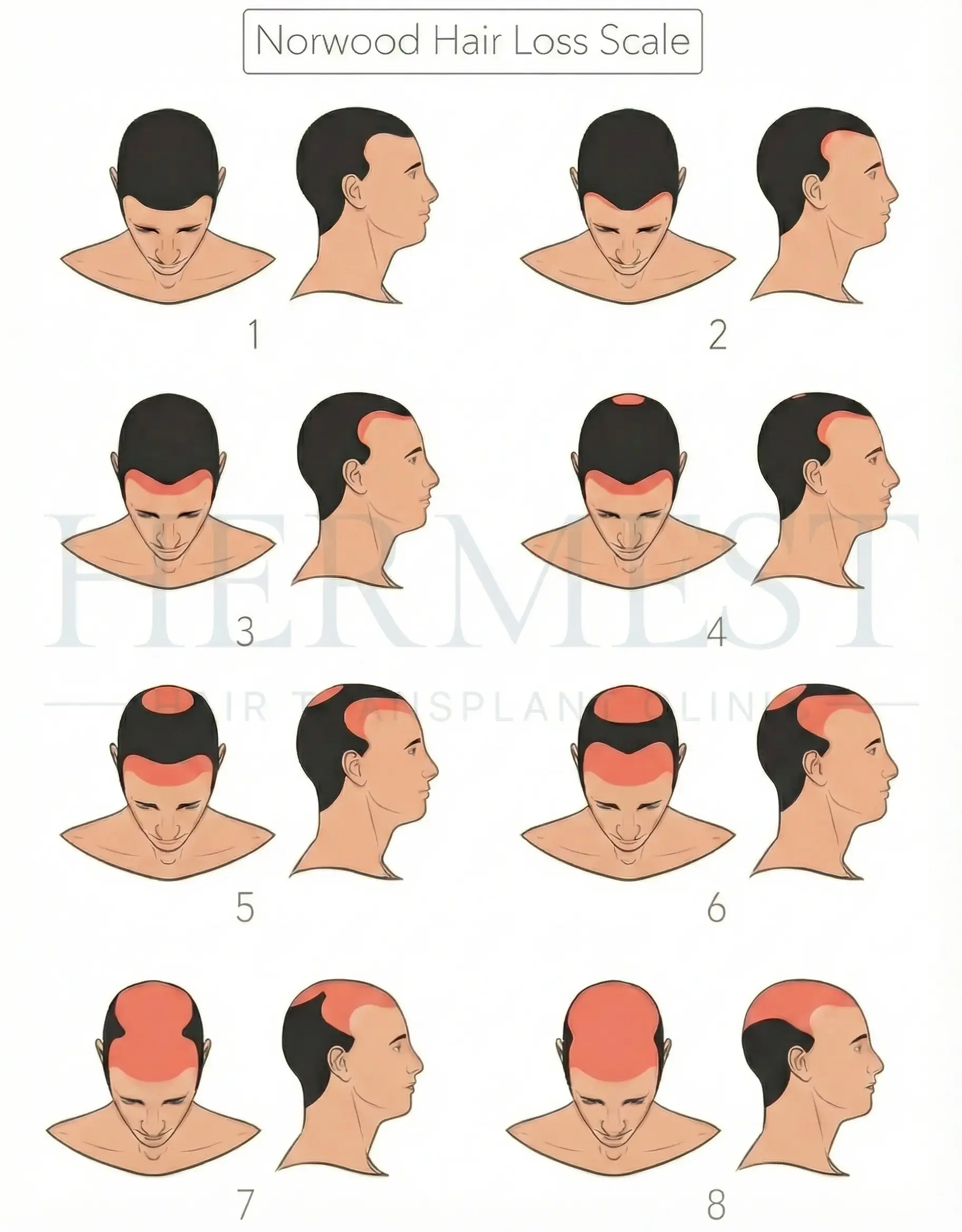 Mature Hairline vs Receding Hairline: Is It Normal Aging or The Start ...